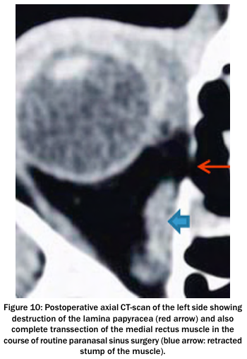 Hosemann_2013_complications_CTO-12-06_fig10.png